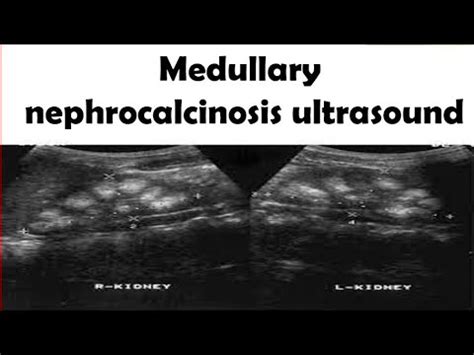 Medullary Nephrocalcinosis Ultrasound Youtube