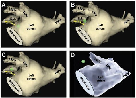Figure 3 From Three Dimensional Electroanatomical Mapping To Guide Endocardial Occlusion Of