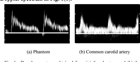 Figure 2 From New Adaptive Clutter Rejection Based On Spectral Analysis In Ultrasound Color Flow