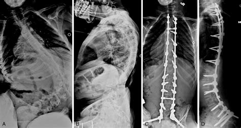 Neuromuscular Spinal Deformities Clinical Tree