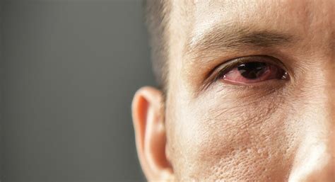 Irritated Eyelids Everything You Need To Know About Blepharitis