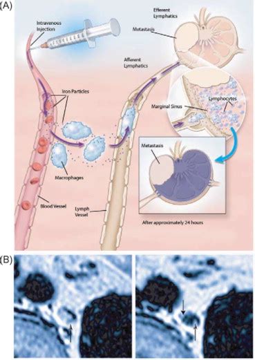 (A) Schematic of injected SPIOs gaining access to the interstitium ...