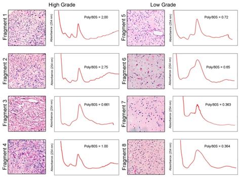 Polysome Profiling Of A Human Glioblastoma Reveals Intratumoral Heterogeneity Abstract