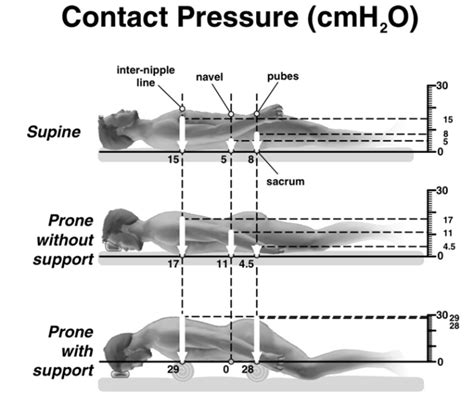 Prone Positioning From Basic Concepts To Practice Triggerlab