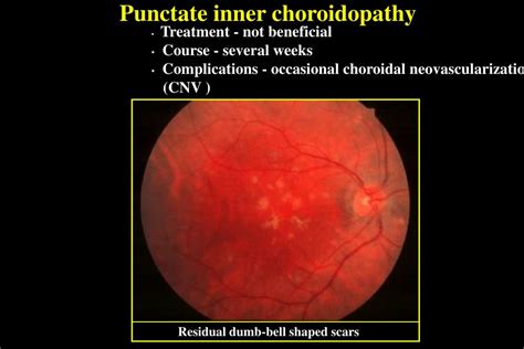 Ppt Idiopathic Inflammatory White Dot Syndromes Powerpoint Presentation Id 1482677