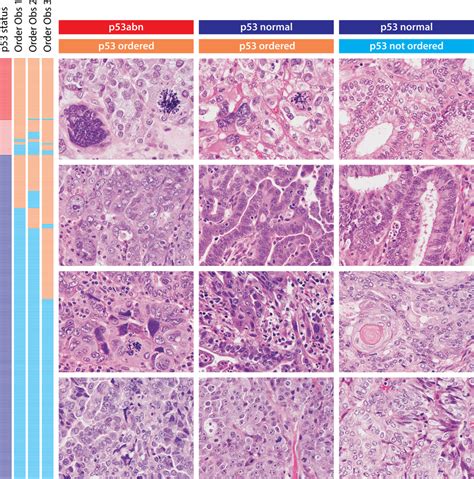 left vertical bar shows the p53 status p53abn red subclonal pink