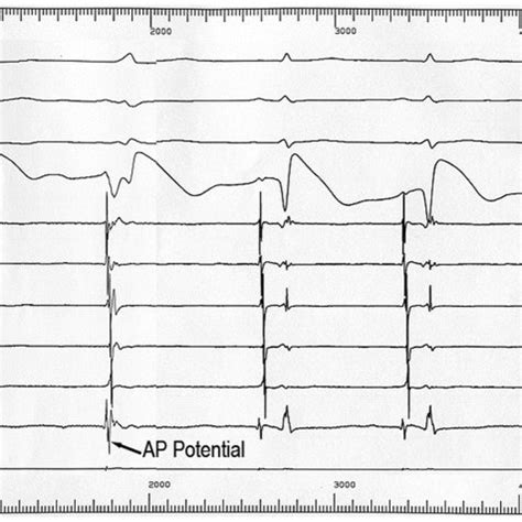 A ECG Showing Minimal Preexcitation RsR Pattern In Lead III Only Download Scientific