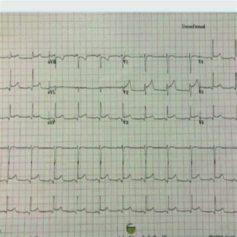 Electrocardiogram Showed Showing Diffuse ST Elevations And PR