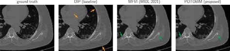 Posterior Temperature Optimized Bayesian Models For Inverse Problems In Medical Imaging