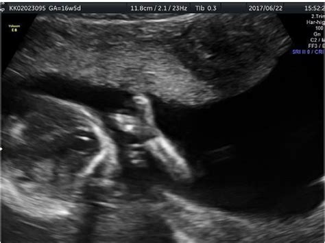 Figure 1 From Prenatal Diagnosis Of Ectrodactyly Ectodermal Dysplasia