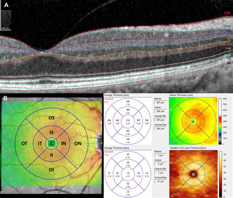 automated macular segmentation performed by the sd oct and etdrs grid
