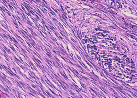 GIST With Spindle Cell Features Ob 10 Download Scientific Diagram