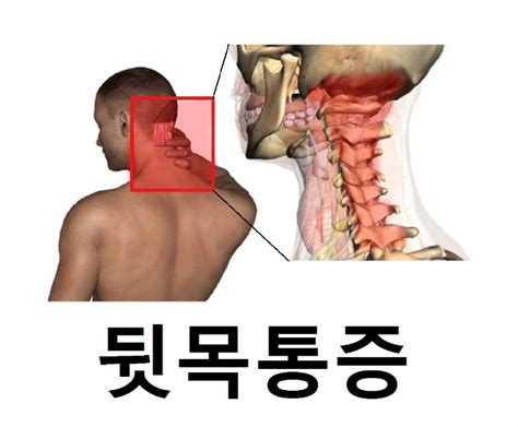 뒷목통증 케이스에 대한 고찰 네이버 블로그