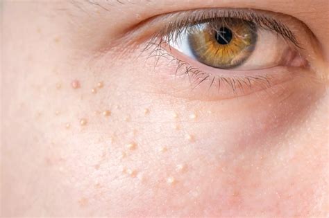 What Those Strange White Bumps On Your Body Actually Are As Private