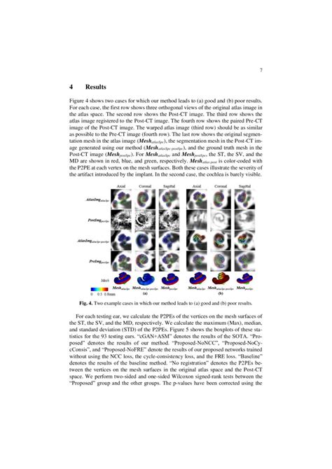 Atlas Based Segmentation Of Intracochlear Anatomy In Metal Artifact