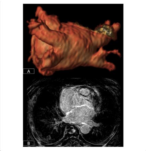 3d Segmentation Of The Left Atrium Depicting Left Atrial Anatomy And Download Scientific
