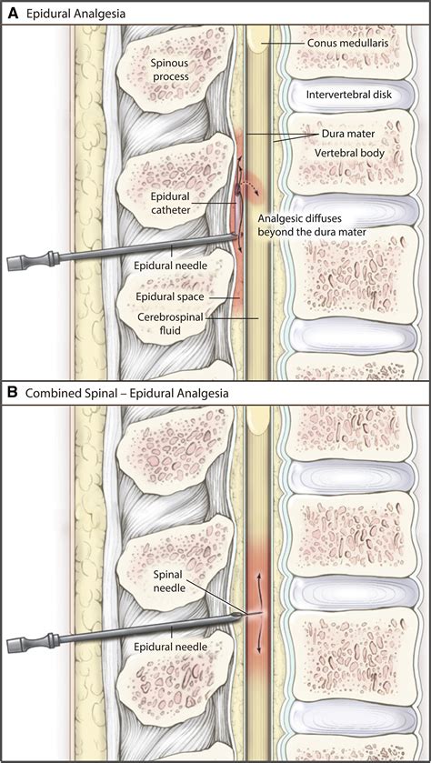 Modern Labor Epidural Analgesia Implications For Labor Outcomes And