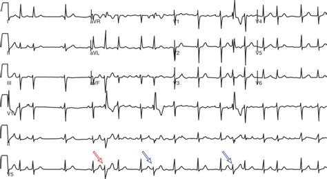 Intraventricular Conduction Abnormalities Thoracic Key