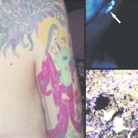 Pdf Abnormal Axillary Lymph Nodes On Negative Mammograms Causes