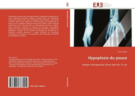 Hypoplasie Du Pouce Von Paul Gasnier 2012 Taschenbuch Online Kaufen