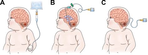 Frontiers Car T Cell Therapy For Pediatric Brain Tumors