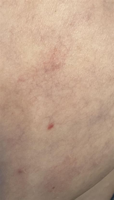 Annular Rash Lesion With Central Clearing R Dermatologyquestions