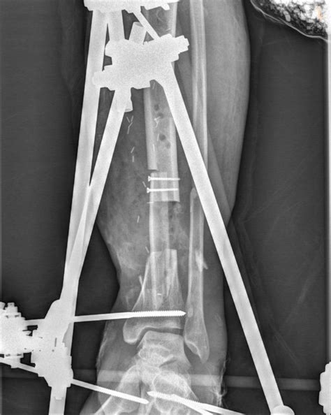 For Tibial Bone Defects 6 Cm Murat Kayalar Prof Dr