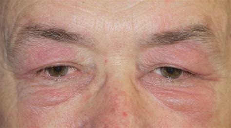 How To Identify And Manage Autoimmune Rashes