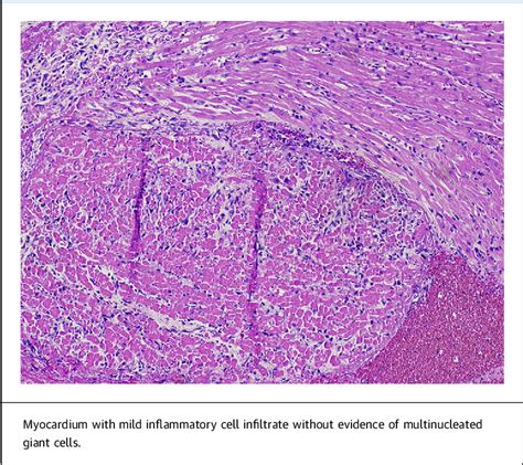 Figure 4 From Peripartum Cardiomyopathy Presenting With Incessant