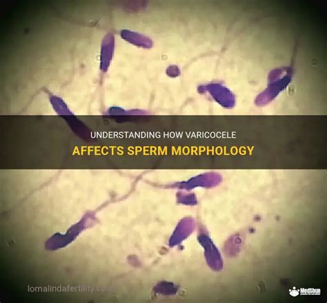 Understanding How Varicocele Affects Sperm Morphology Medshun