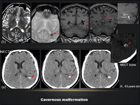 Figure 18 From Computed Tomography Patterns Of Intracranial Calcifications Always Easy To