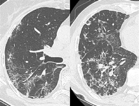 Reticular Interstitial Pattern