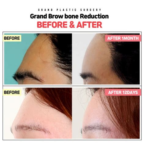 Brow Bone Reduction