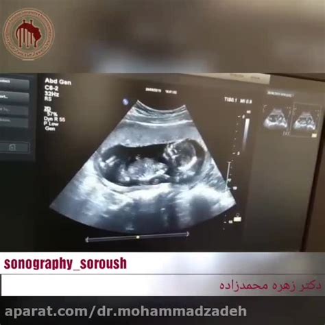 فیلم سونوگرافی جنین دوقلو سونوگرافی سروش دکتر محمد زاده تماشا