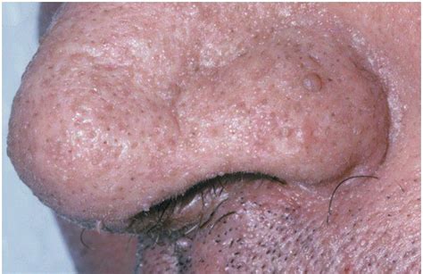 Multiple Hamartoma Syndrome Medizzy