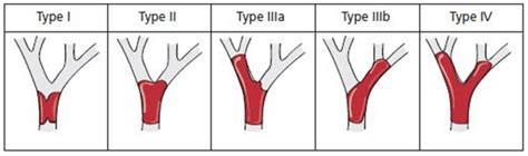 Schematic Diagram Of The Bismuth Corlette Classification Of Hilar Download Scientific Diagram