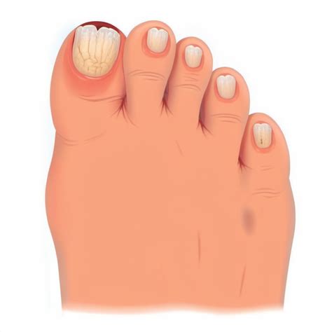 Nail Fungus Treatment Stable Diffusion Online