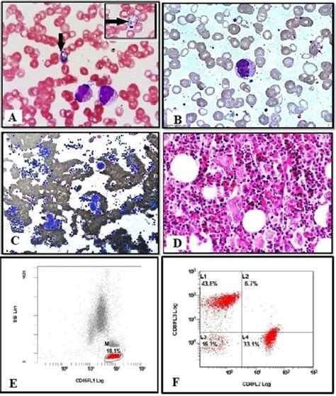 A Pbs Shows Normocytic Normochromic To Microcytic Hypochromic Rbcs