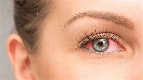 Common Causes Of Eye Redness