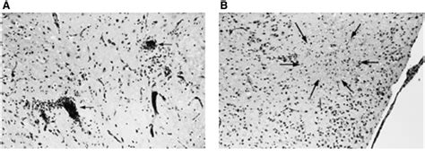 Lesion In The Brain Of Infected Mouse The Section Was Stained With