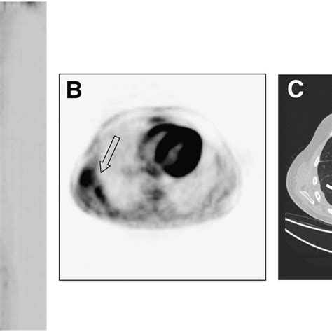 Images For 23 Y Old Male Patient Who Had Ewing Sarcoma In Right Tibia Download Scientific