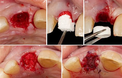 A Depending On The Size Of The Extraction Socket About 6 10 Small Download Scientific