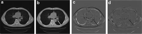 Subtraction Techniques For Ct And Dsa And Automated Detection Of Lung Nodules In 3d Ct