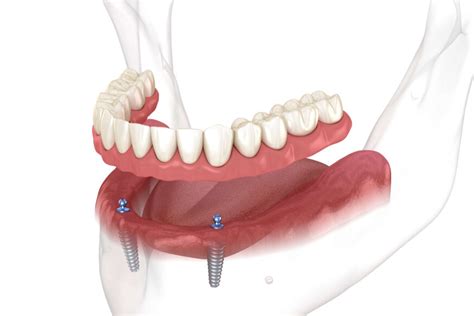Implant Overdenture Steps And Clinical Protocol Dandy