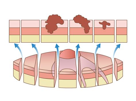 mohs surgery vs wide excision what are the differences bangkok