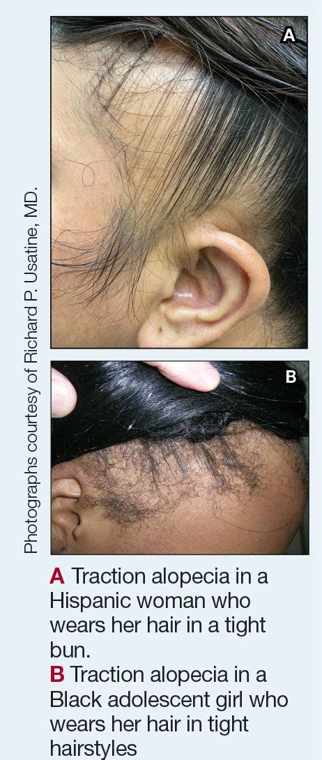 Home Remedies For Traction Alopecia