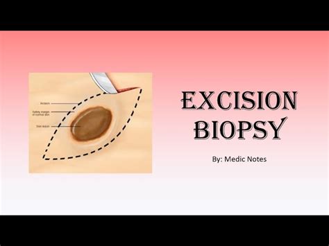 Excision Biopsy Break Down The Differences Between Excision And