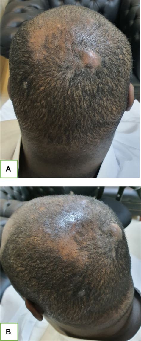 Dissecting Cellulitis Dc Of The Scalp A Case Report Ccid
