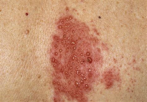 Herpes On Lower Back