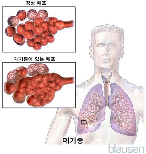 만성 폐쇄성 폐질환 Copd 만성 폐쇄성 폐질환 Copd Msd 매뉴얼 일반인용